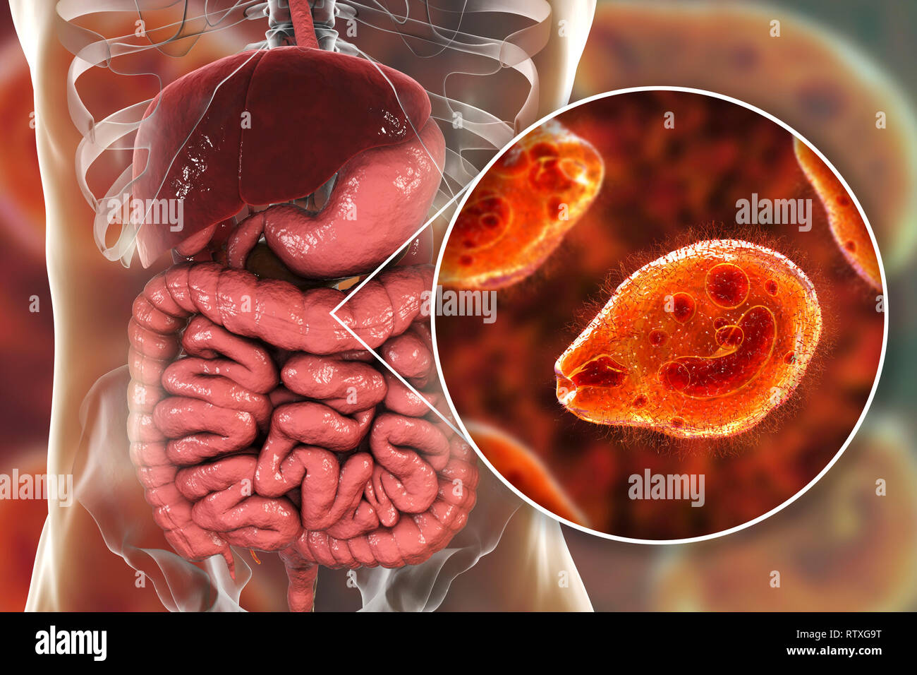 Balantidiasis, conceptual image. Computer illustration showing close-up ...