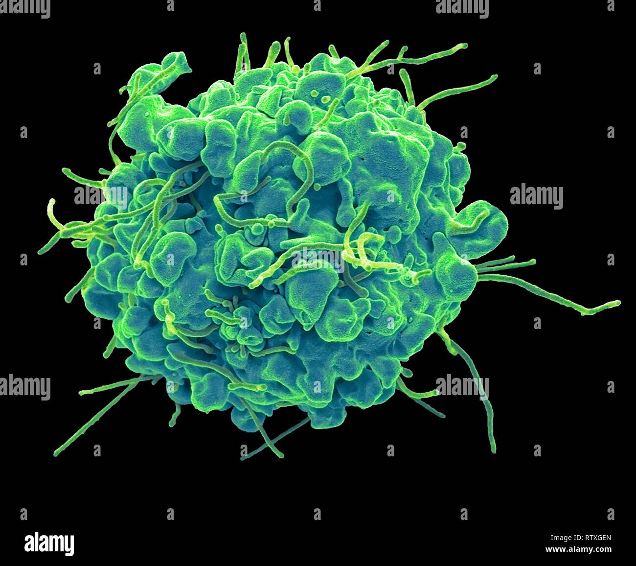 Apoptosis. Coloured scanning electron micrograph (SEM) of a 293T cell ...