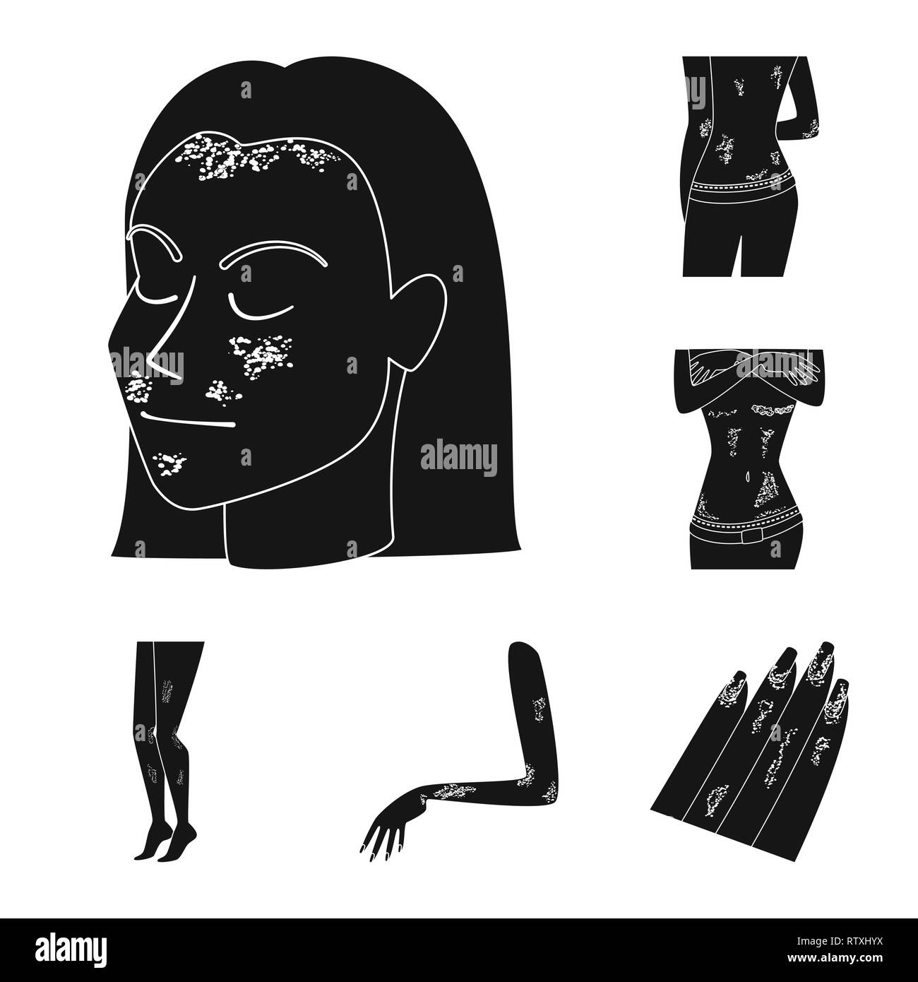 psoriasis,skin,body,dermatitis,chronic,allergy,eczema,itch,rash,stress ...