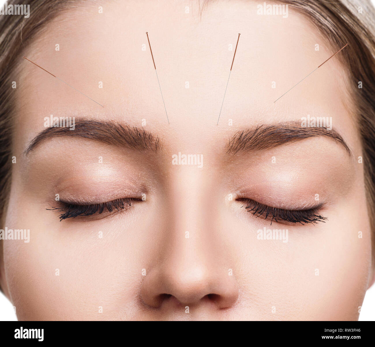 Young female face with inserted needles. Woman undergoing acupuncture ...