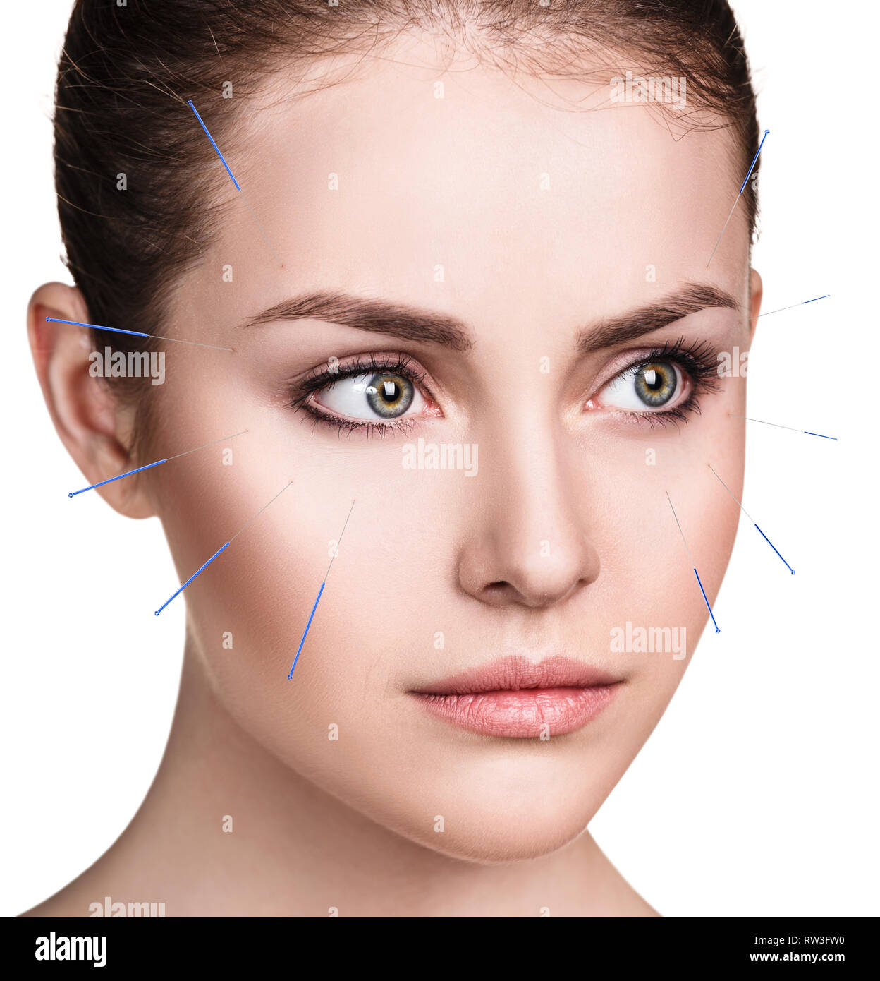 Young female face with inserted needles. Woman undergoing acupuncture ...