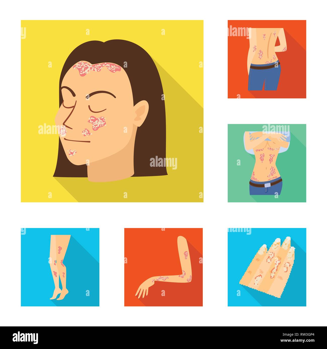 psoriasis,skin,body,dermatitis,girl,allergy,rash,hand,peeling,head,back ...