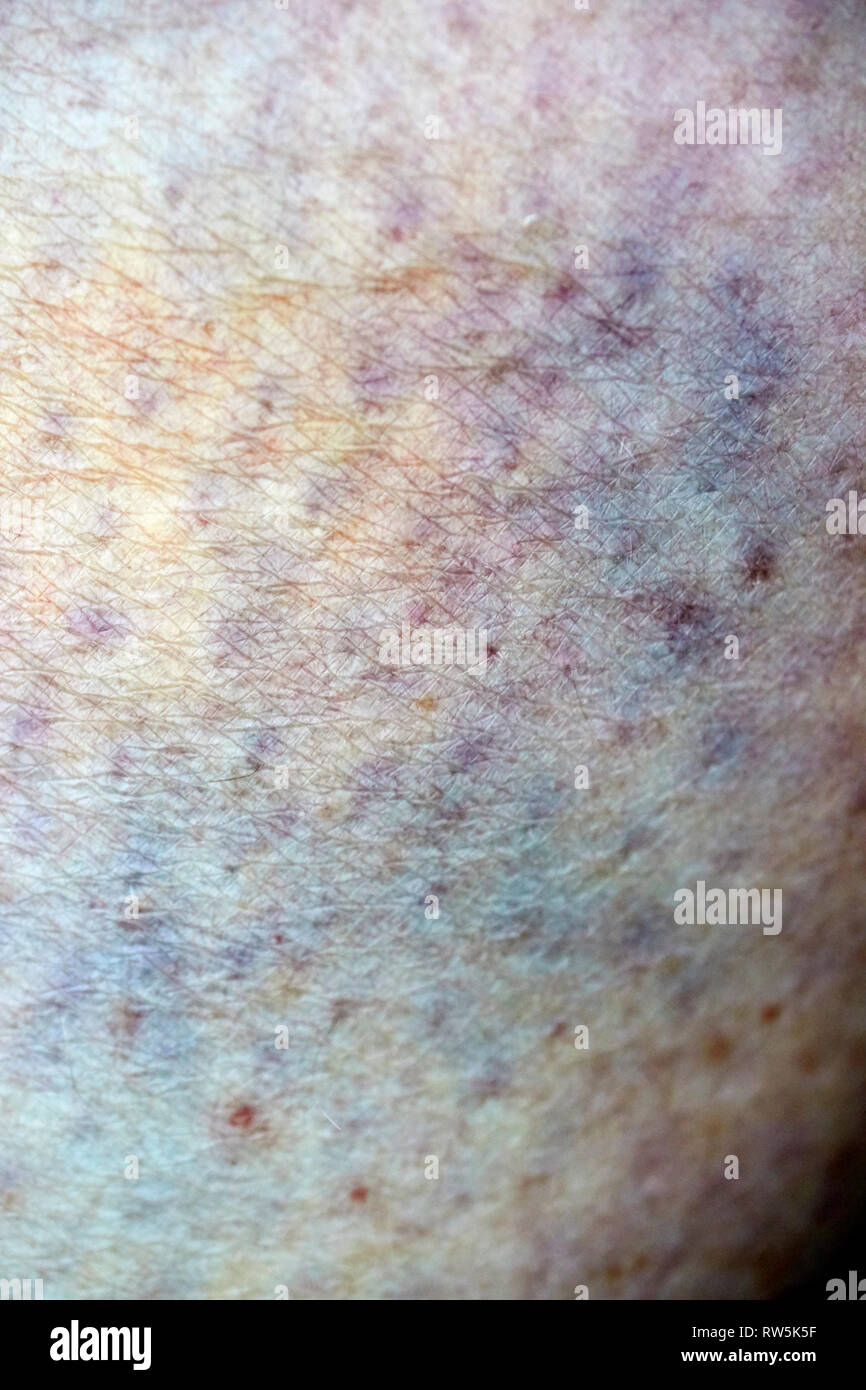 Bruise and leg hi-res stock photography and images - Alamy