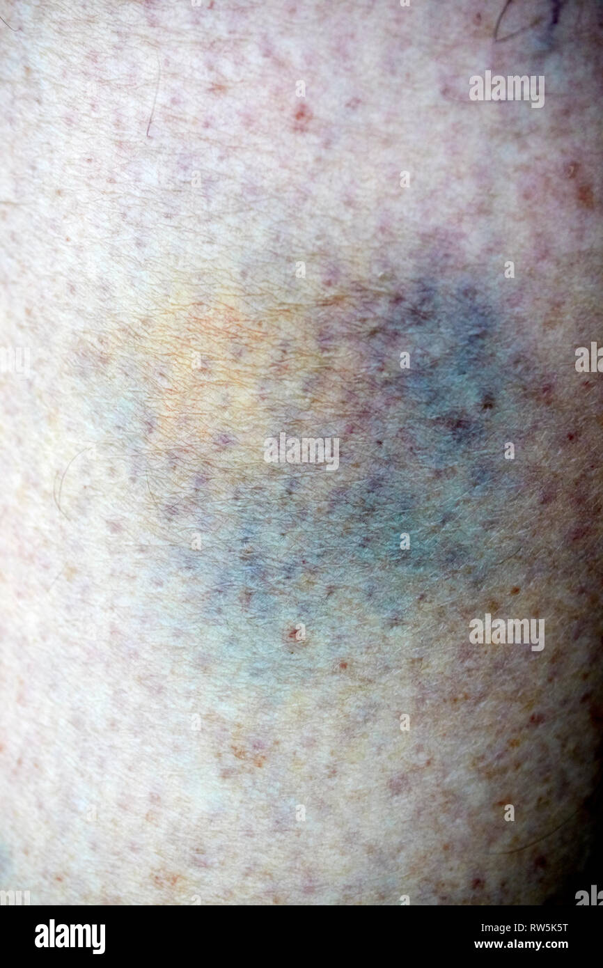 different colours of a bruise on a mans leg Stock Photo - Alamy
