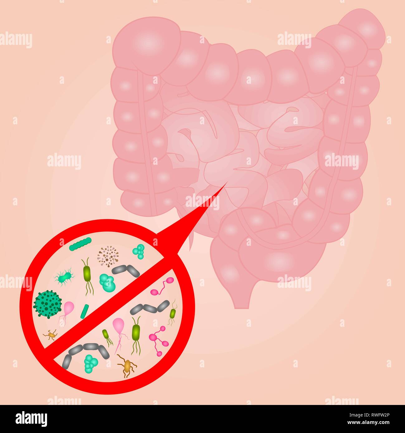 Small intestine bacterial overgrowth hi-res stock photography and ...