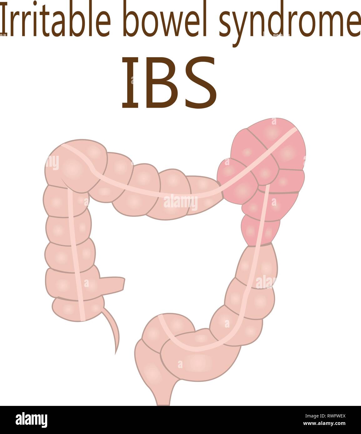 Irritable bowel syndrome (IBS) in a large intestine vector illustration ...