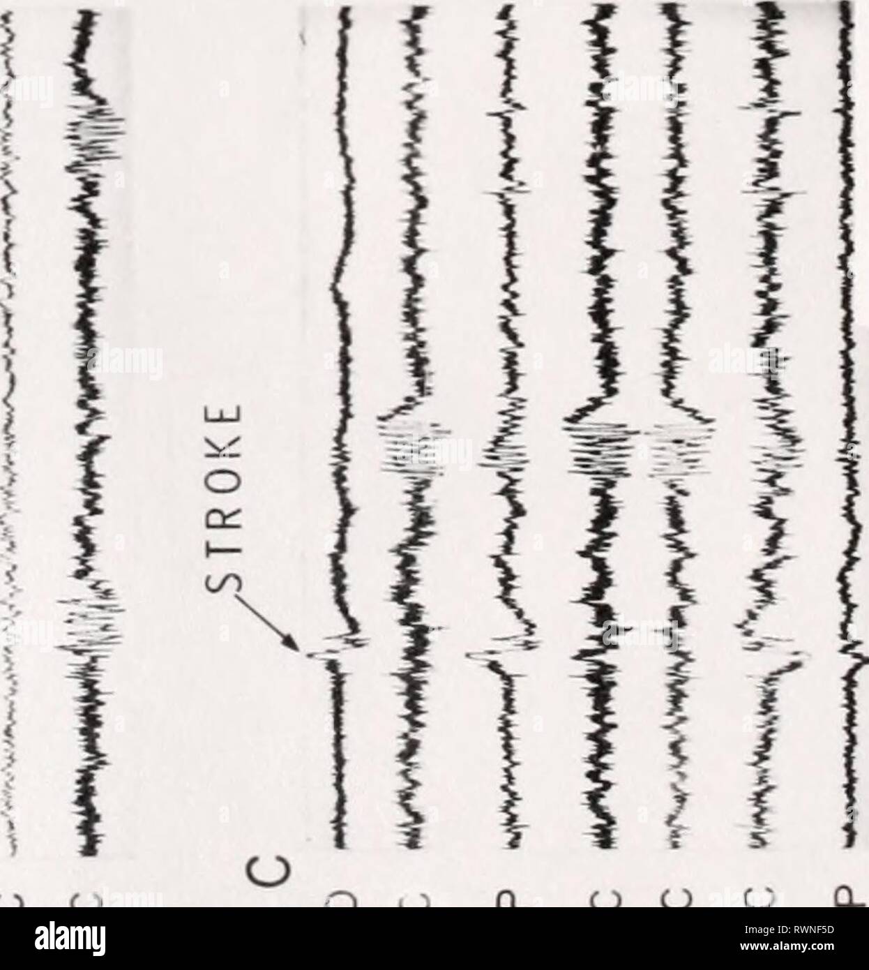 Y syndrome hi-res stock photography and images - Alamy