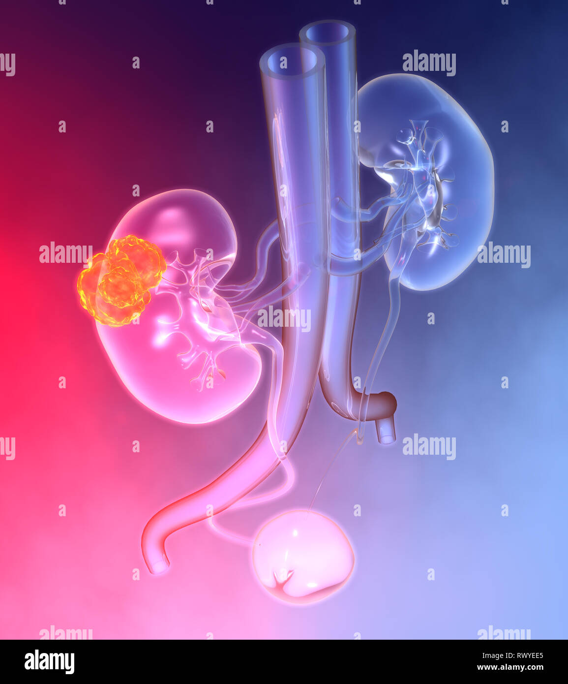 Illustration showing a kidney tumor and bÃ¶ood vessels, ureter and ...