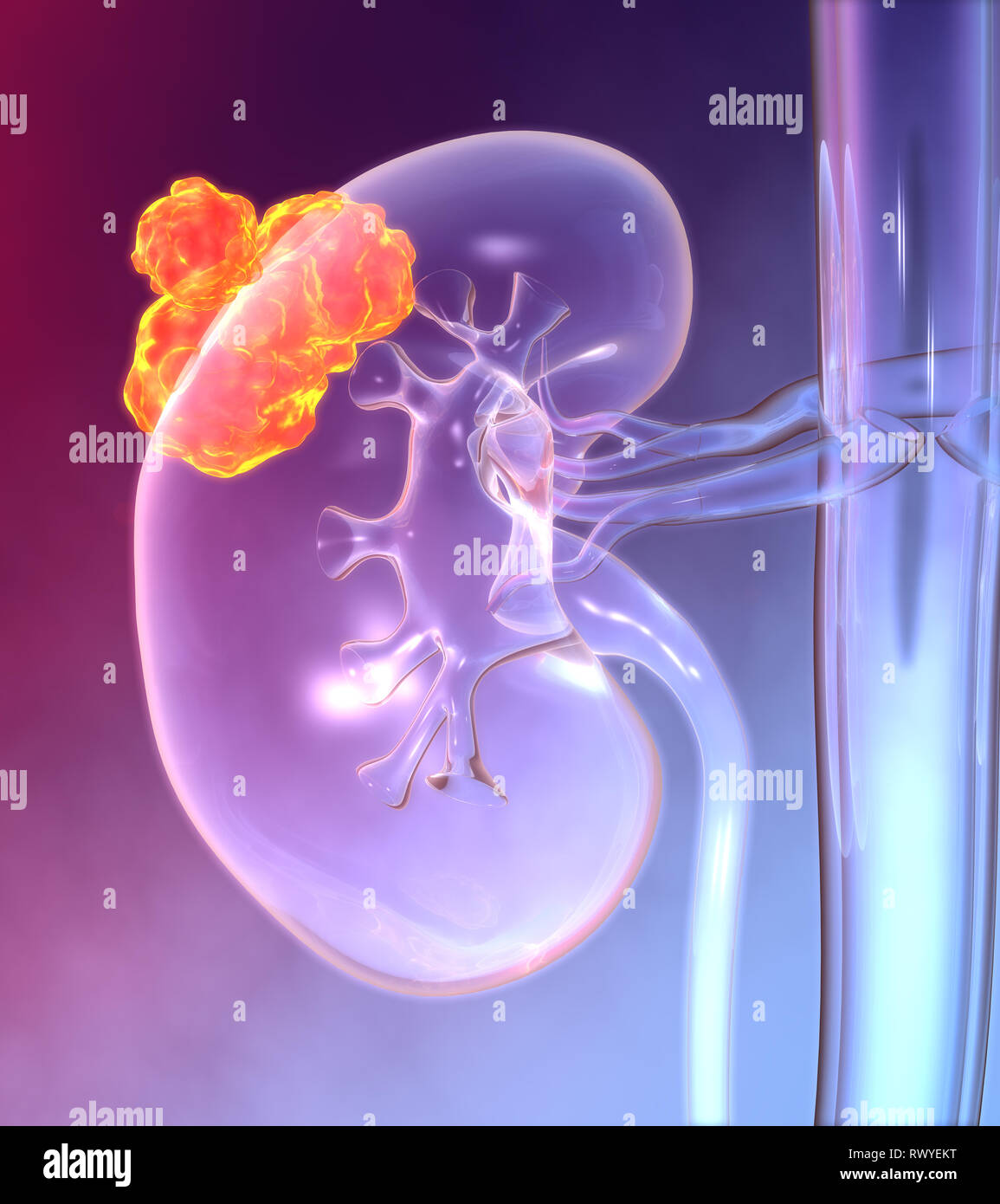 Illustration showing a kidney tumor on colorful background Stock Photo ...
