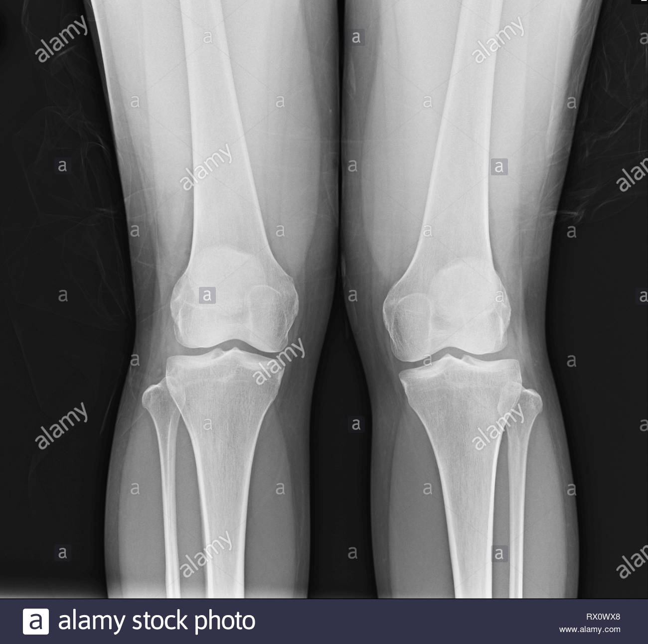 Normal Knee X Ray Stock Photos & Normal Knee X Ray Stock Images - Alamy