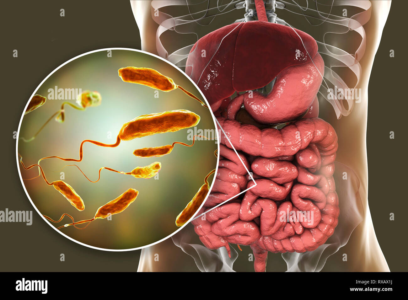 Cholera infection, illustration Stock Photo - Alamy