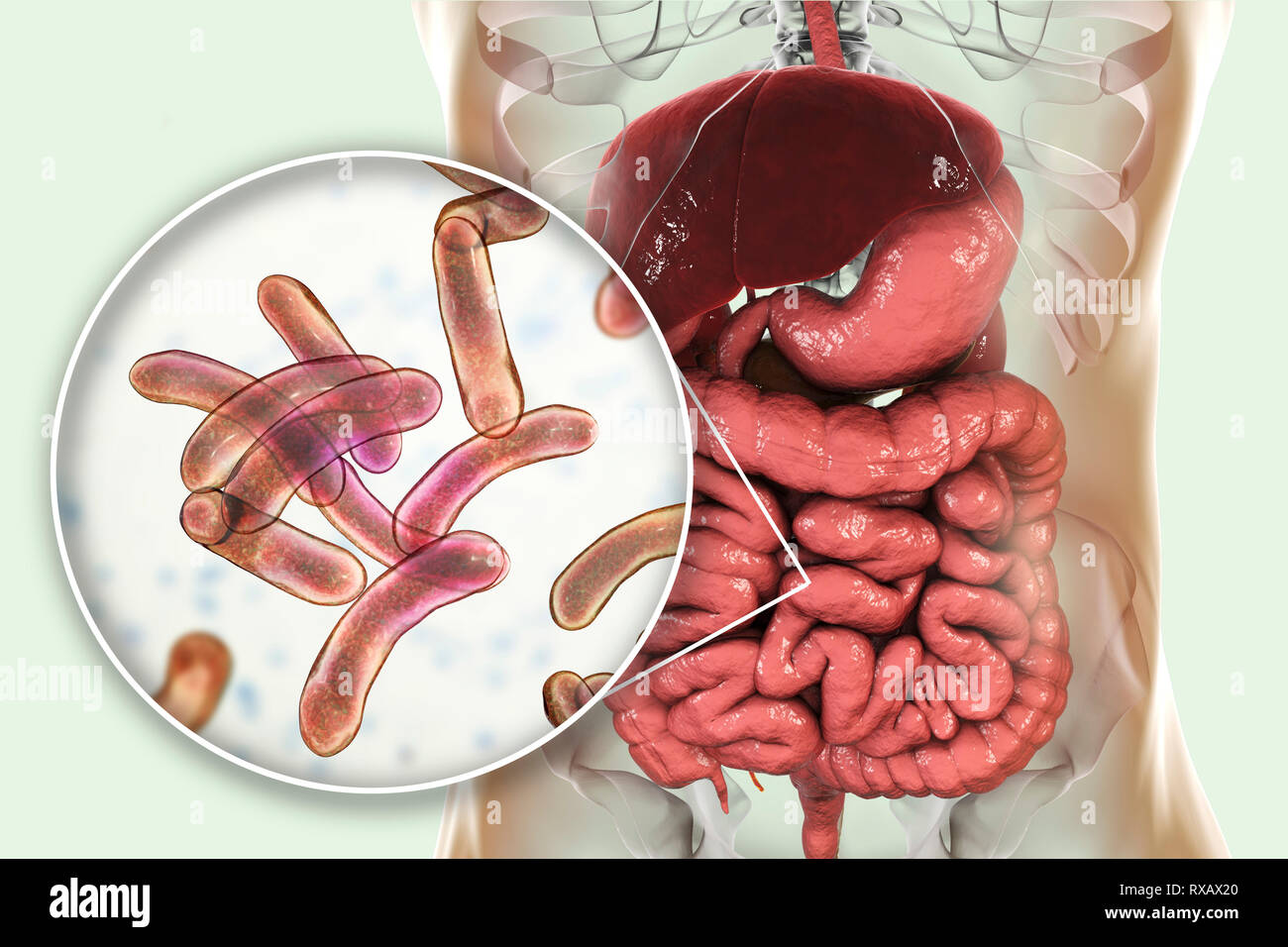 Cholera infection, illustration Stock Photo - Alamy