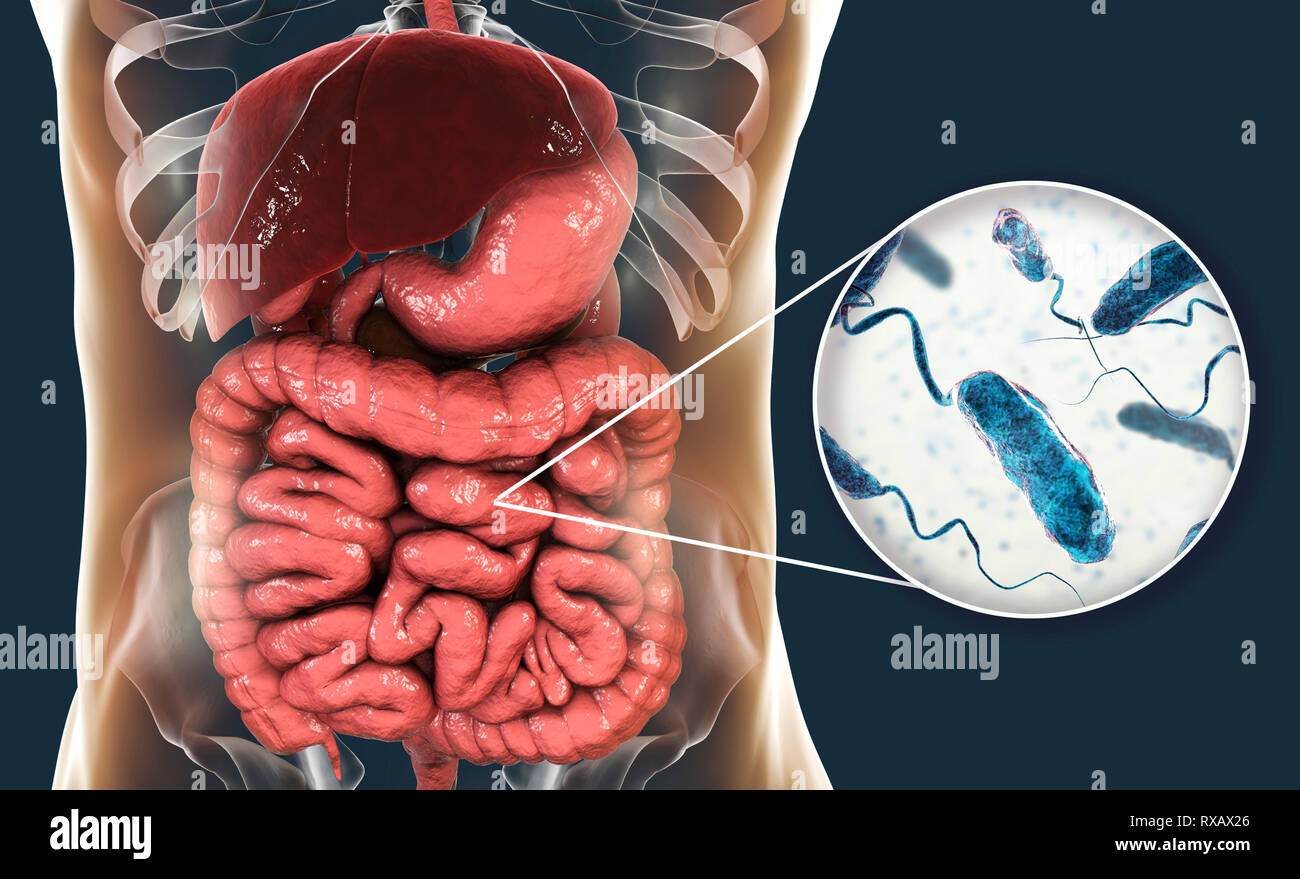 Cholera infection, illustration Stock Photo - Alamy