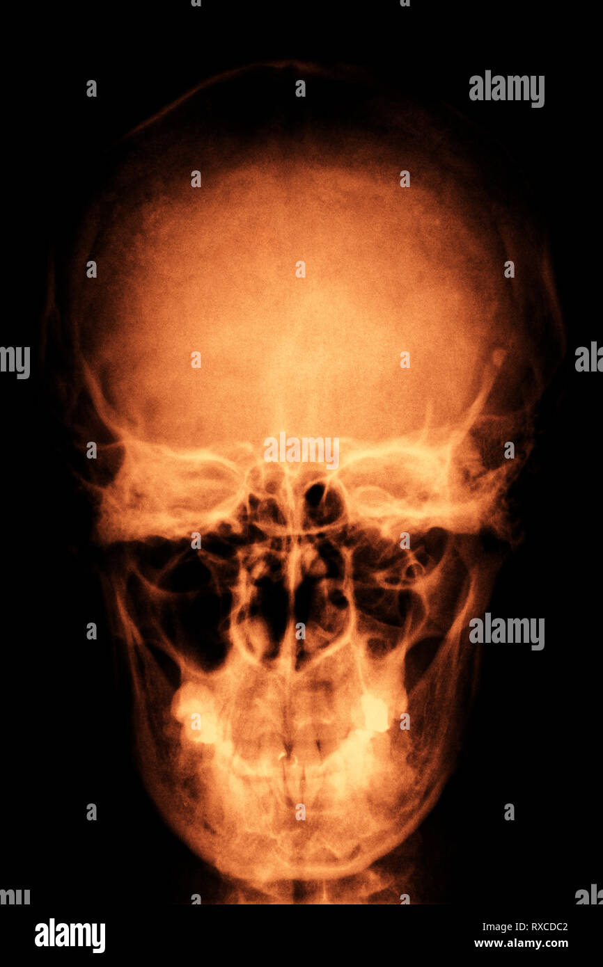 Human head x-ray skull radiology concept Stock Photo - Alamy