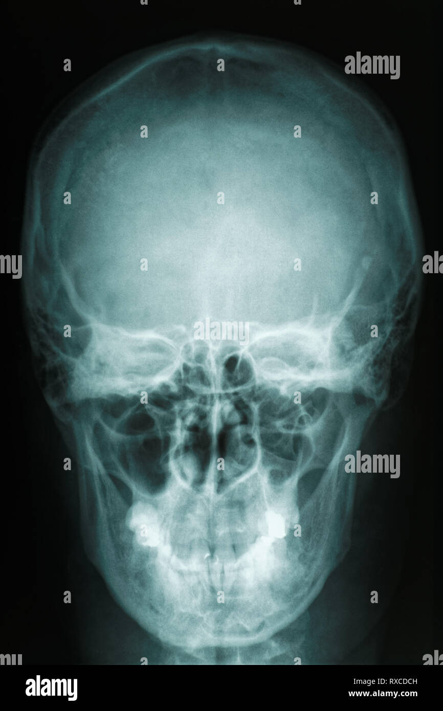 Human head x-ray skull radiology concept Stock Photo - Alamy