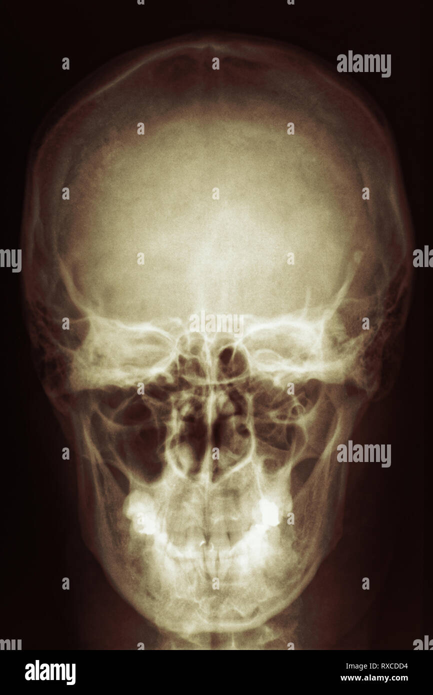 Human head x-ray skull radiology concept Stock Photo - Alamy