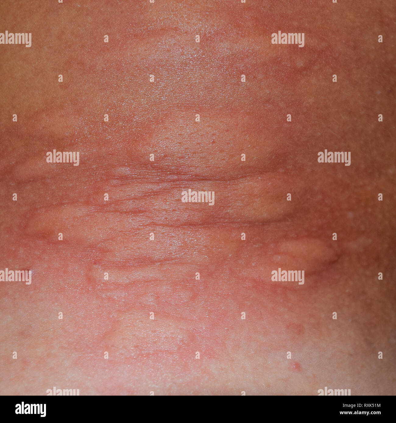 Allergy skin back and sides. Allergic reactions on the skin in the form ...
