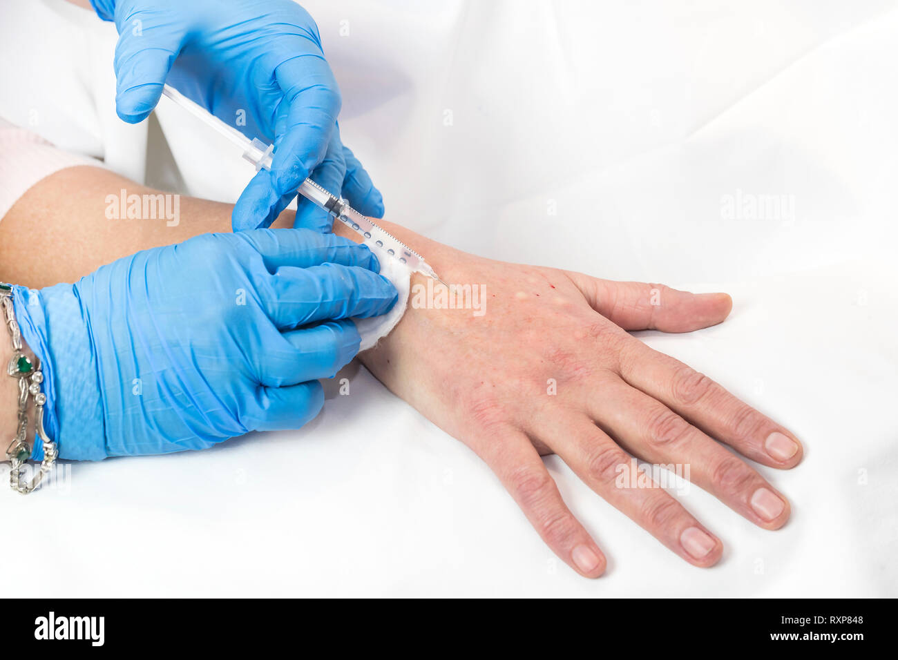 Mesotherapy process on a female hand in clinic Stock Photo - Alamy