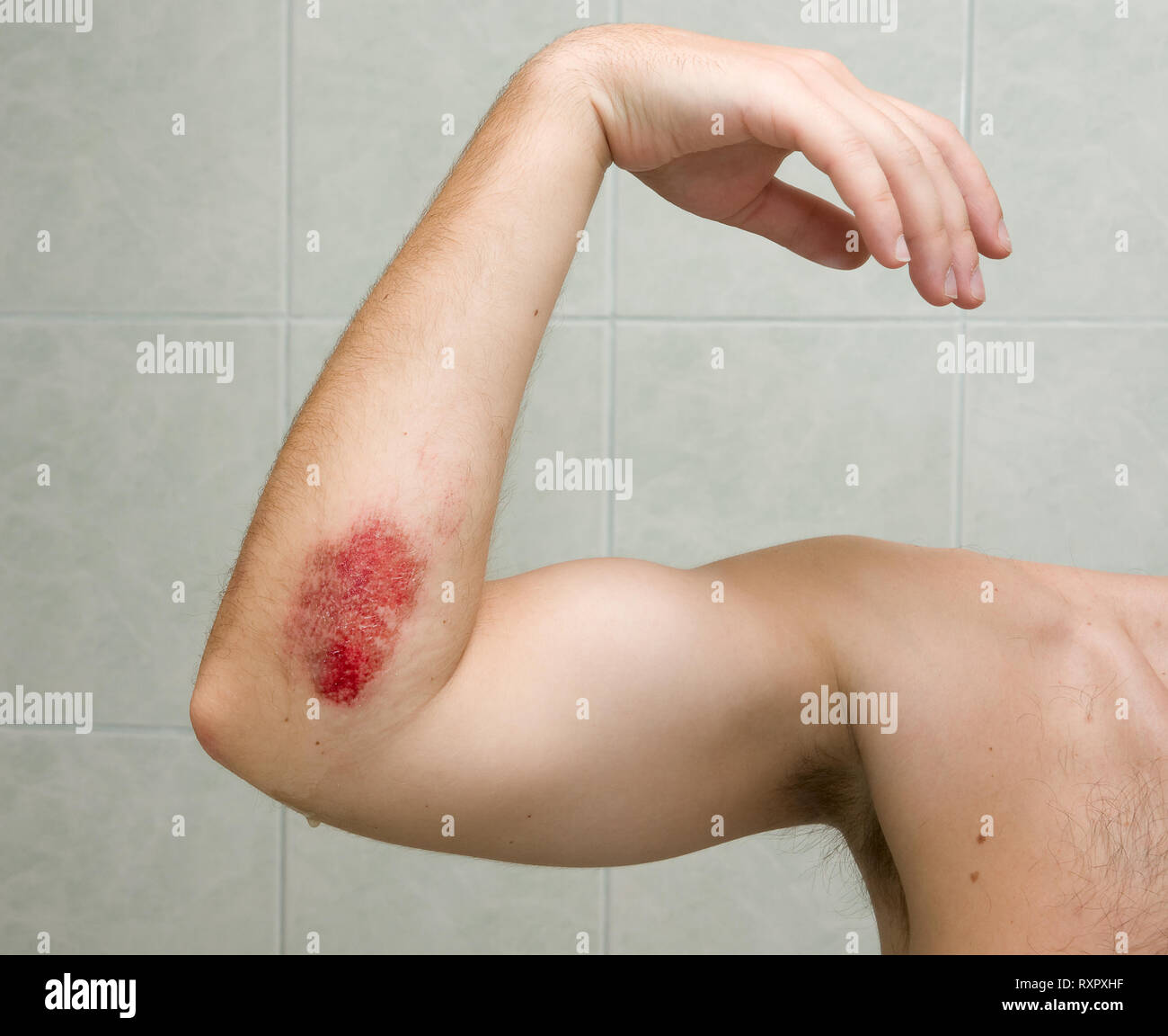 Skating accident hi-res stock photography and images - Alamy