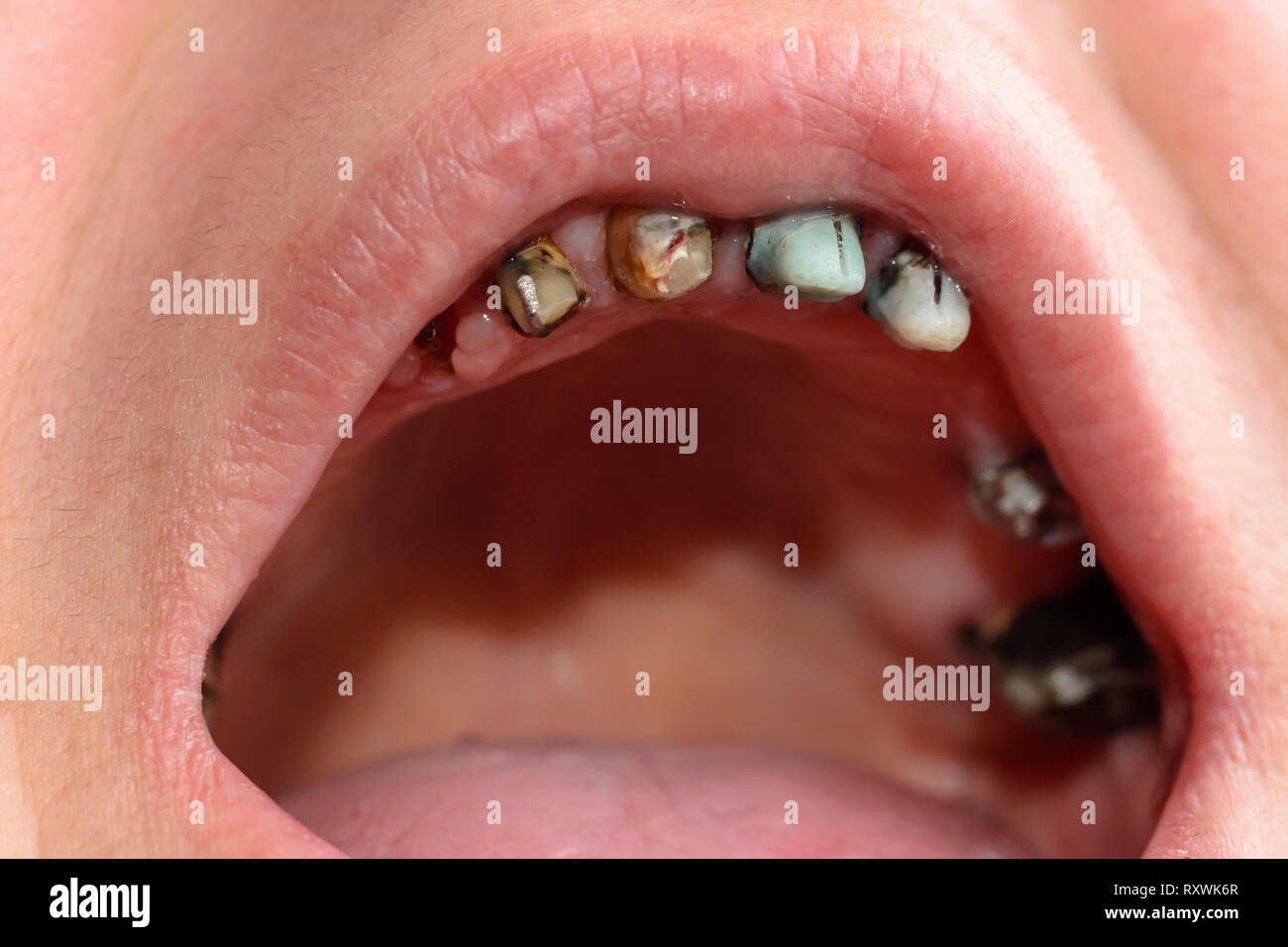 Rotten Teeth High Resolution Stock Photography and Images - Alamy