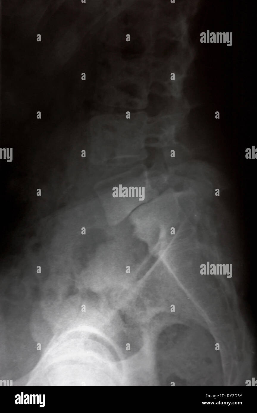 X-ray medical picture - Backbone and vertebrae Stock Photo - Alamy