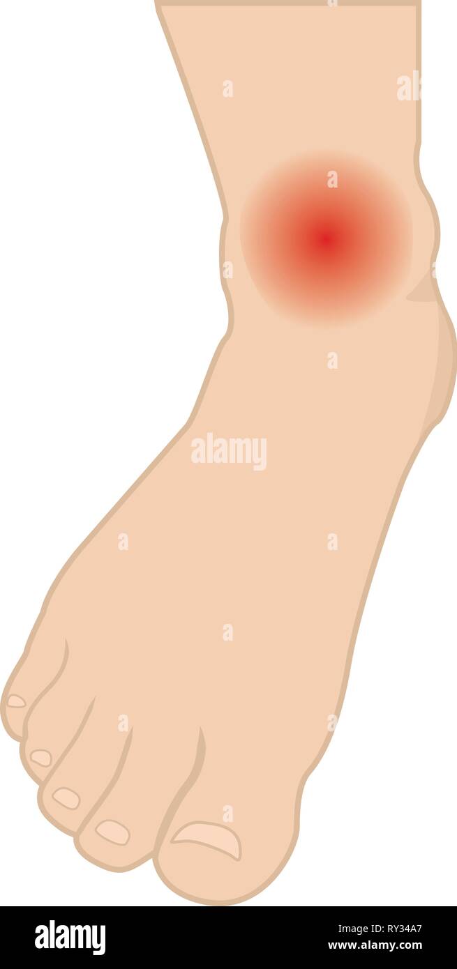 Swelling of the feet and ankles from infected or injury Stock Vector ...