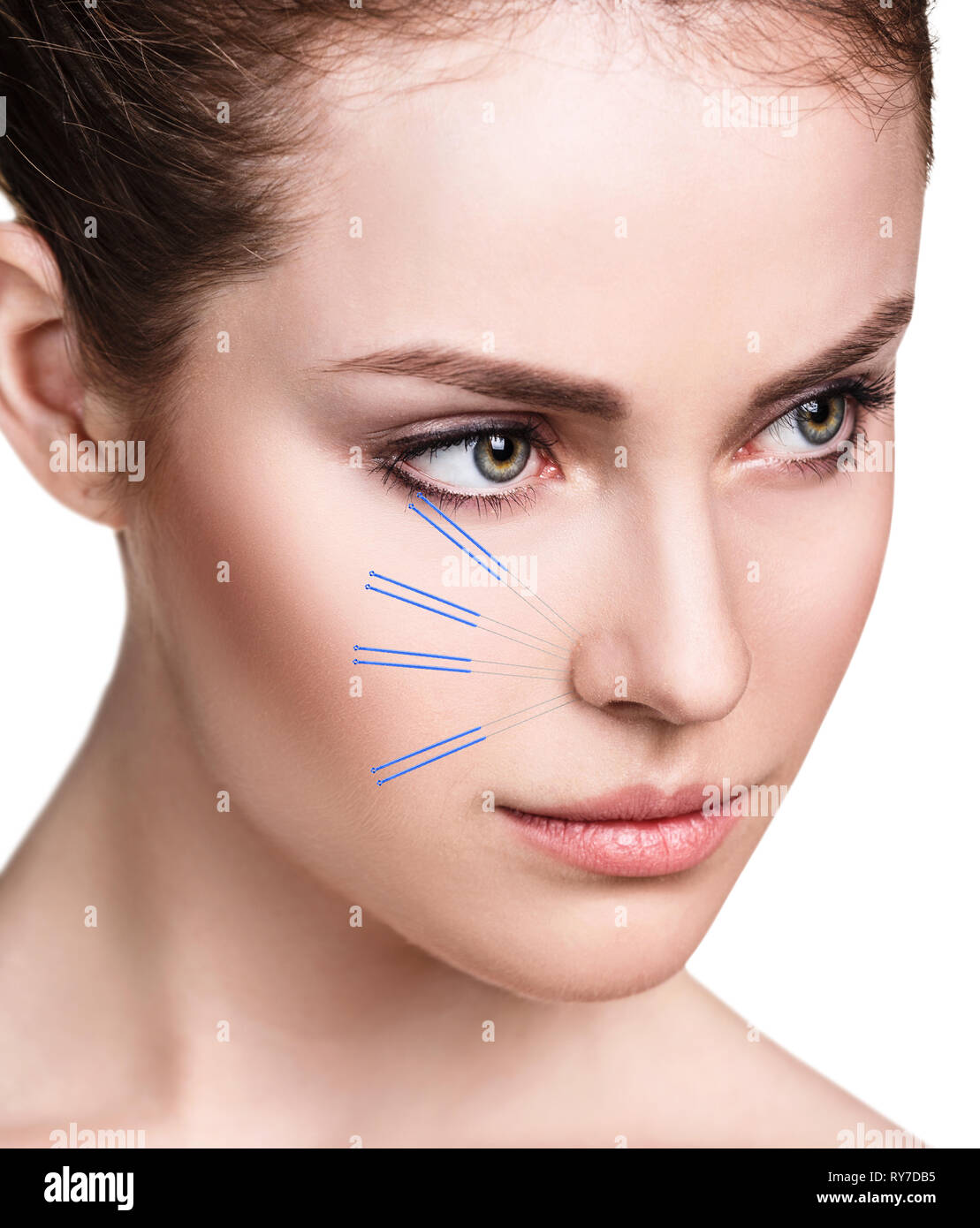 Young female face with inserted needles. Woman undergoing acupuncture ...