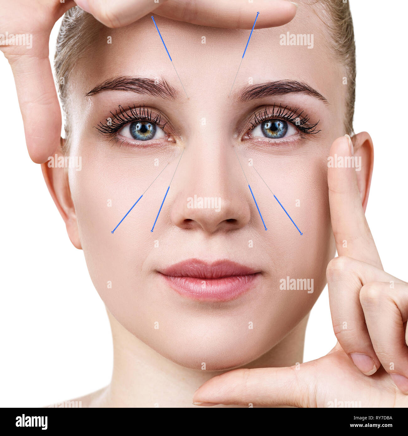 Young female face with inserted needles. Woman undergoing acupuncture ...