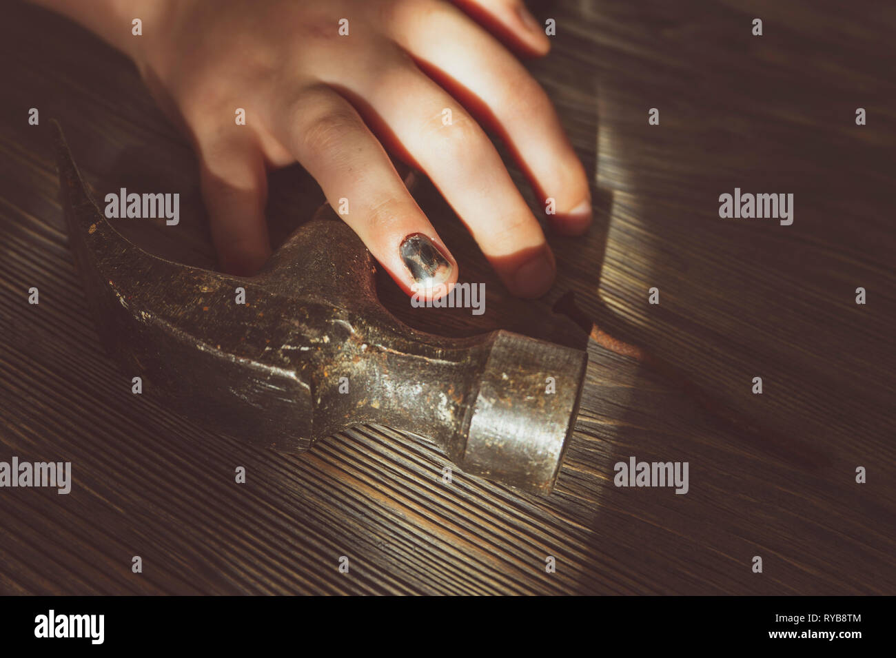 Injured hand with blackened and bruised thumbnail from bashing it ...