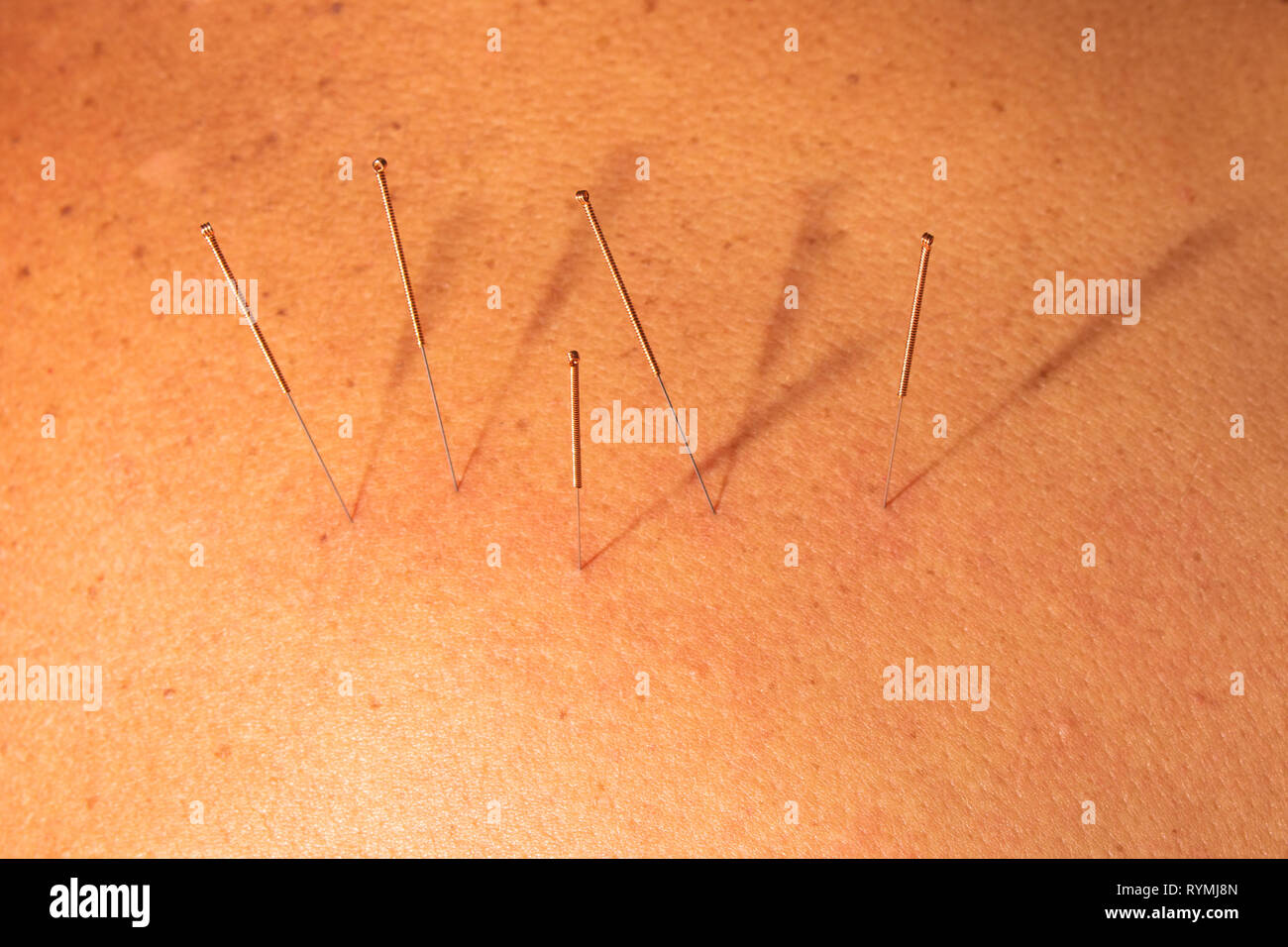 Ancient Chinese Acupuncture Needles