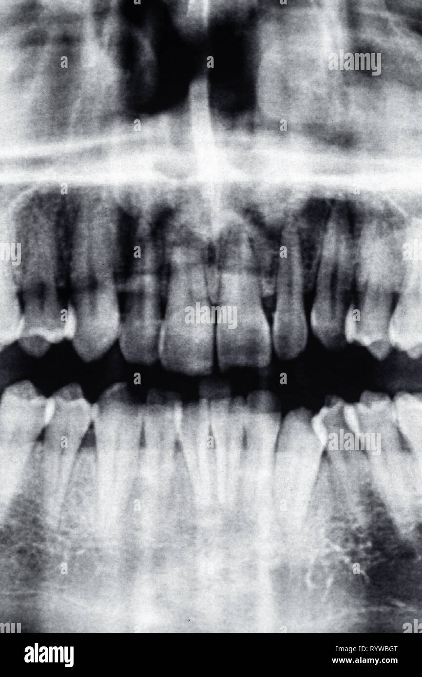 Xray Of Front Teeth