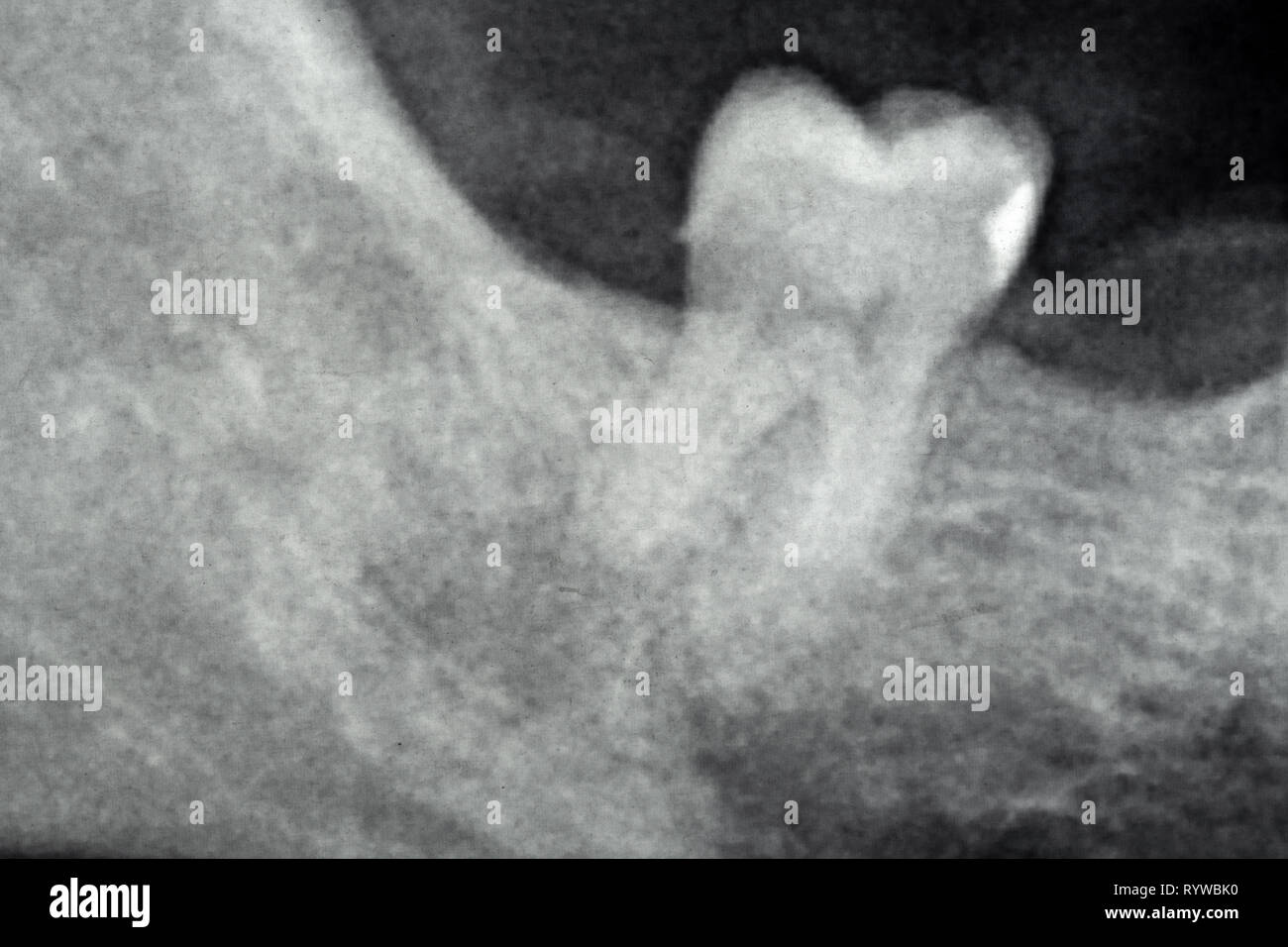 Dental X-Ray or the rith side back tooth Stock Photo - Alamy