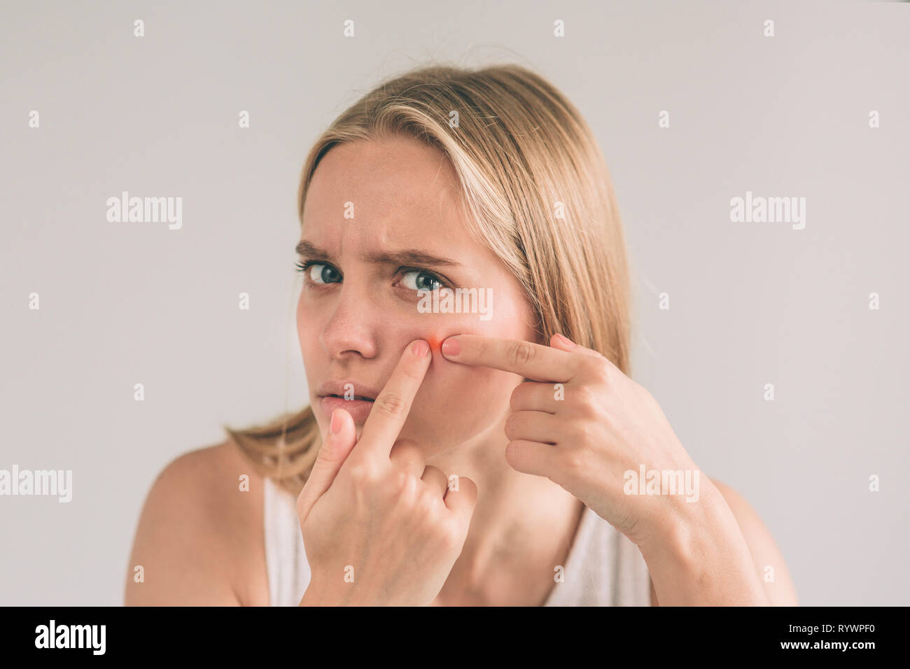Acne treatment. Acne woman. Young woman squeezing her pimple, removing ...