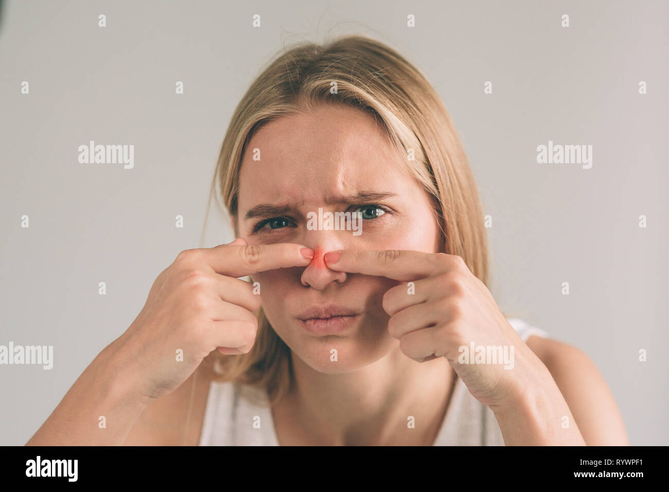 Acne treatment. Acne woman. Young woman squeezing her pimple, removing ... Acne treatment. Acne woman. Young woman squeezing her pimple, removing ...
