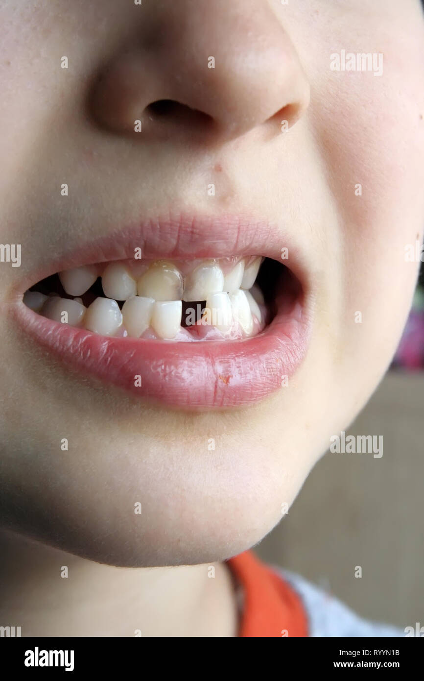 Child missing tooth. Kid missing one tooth. Gap between kids teeth ...