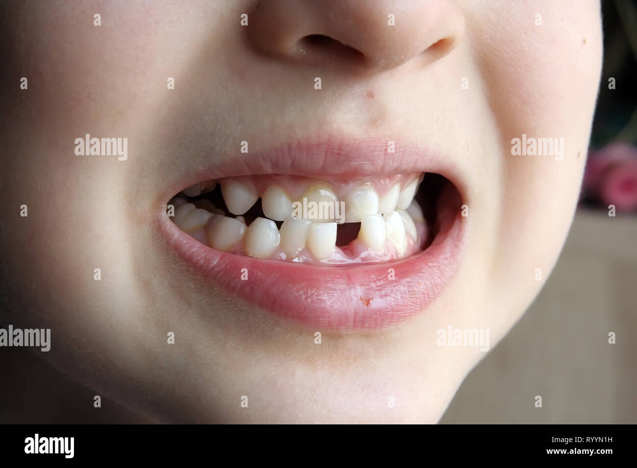 Child missing tooth. Kid missing one tooth. Gap between kids teeth ...