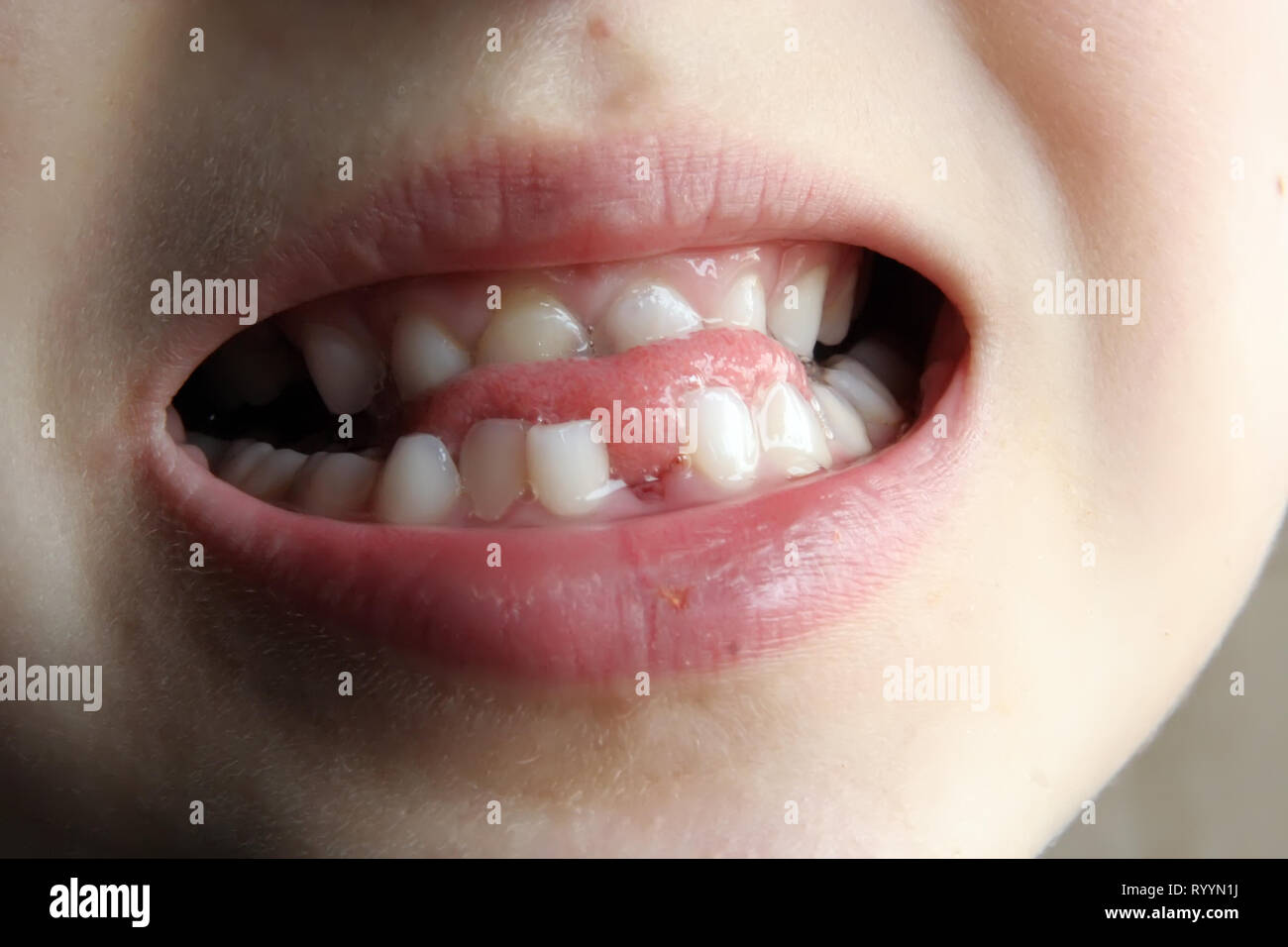 Child missing tooth. Kid missing one tooth. Gap between kids teeth ...