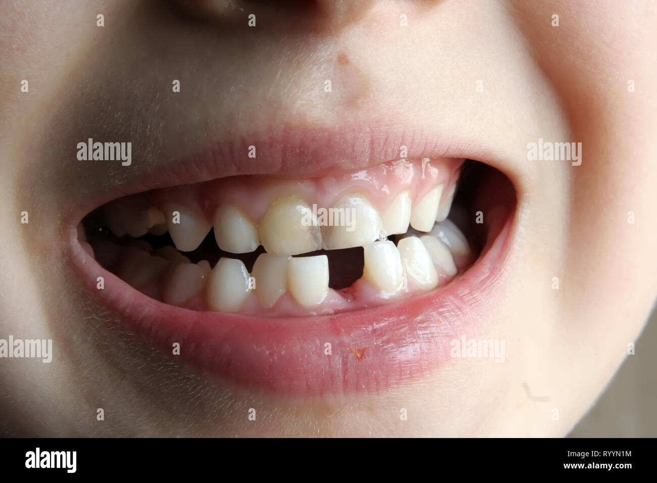 Child missing tooth. Kid missing one tooth. Gap between kids teeth ...