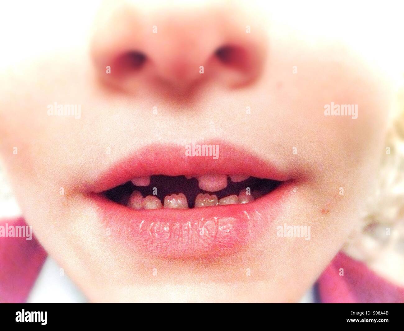 Young girl with missing front tooth Stock Photo - Alamy