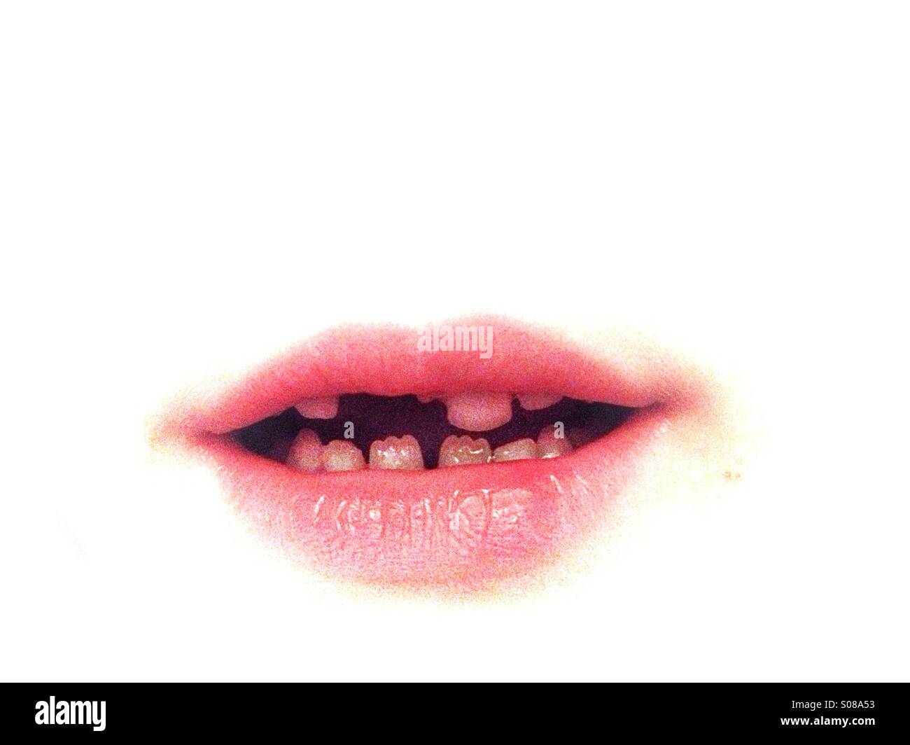 Teeth missing hi-res stock photography and images - Alamy