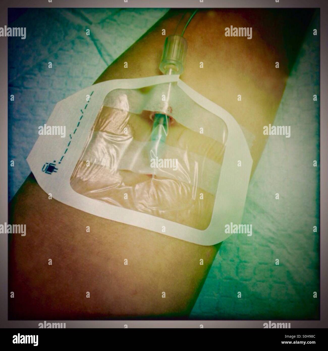 Iv in arm hi-res stock photography and images - Alamy