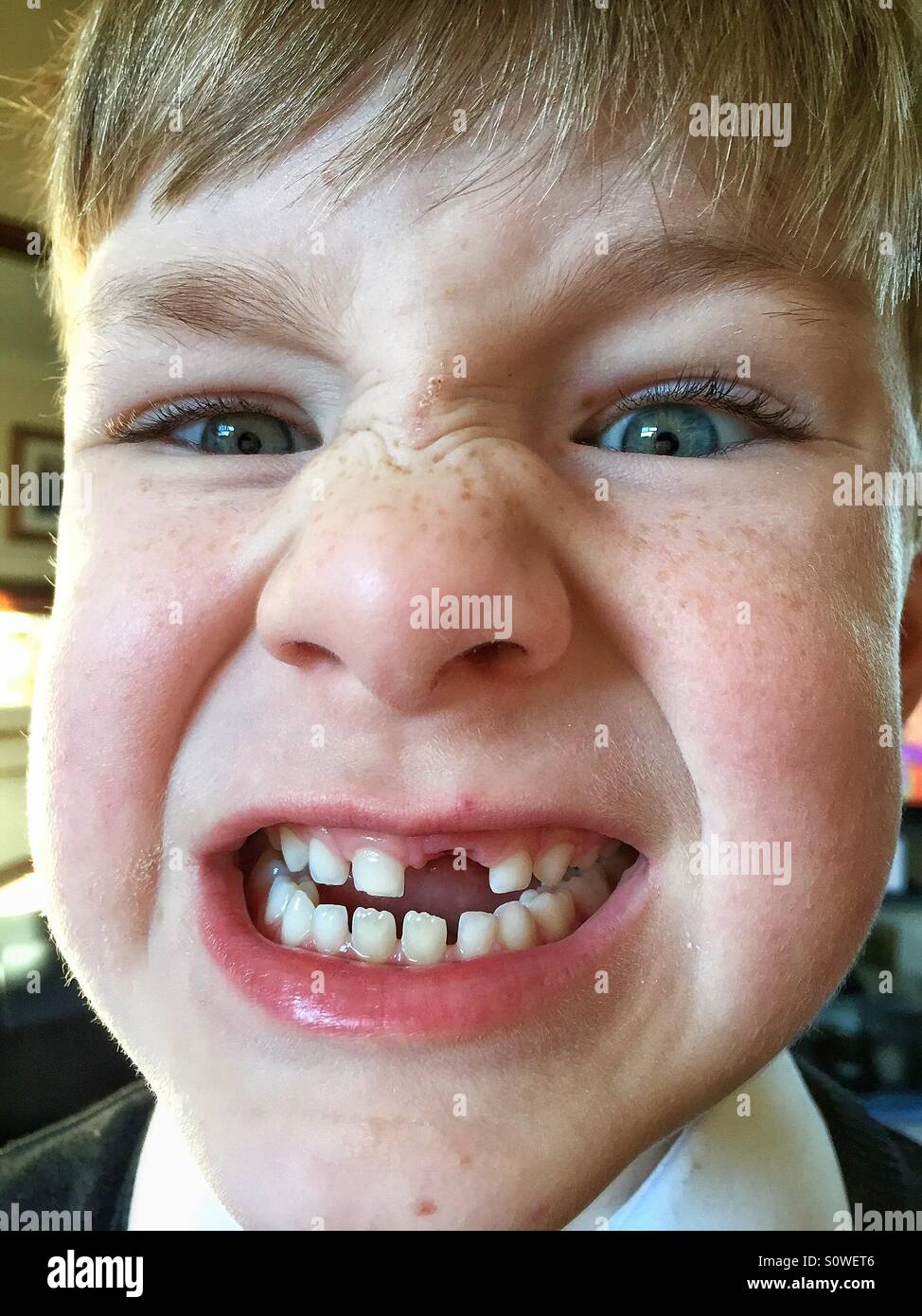 Tooth fallen out hi-res stock photography and images - Alamy