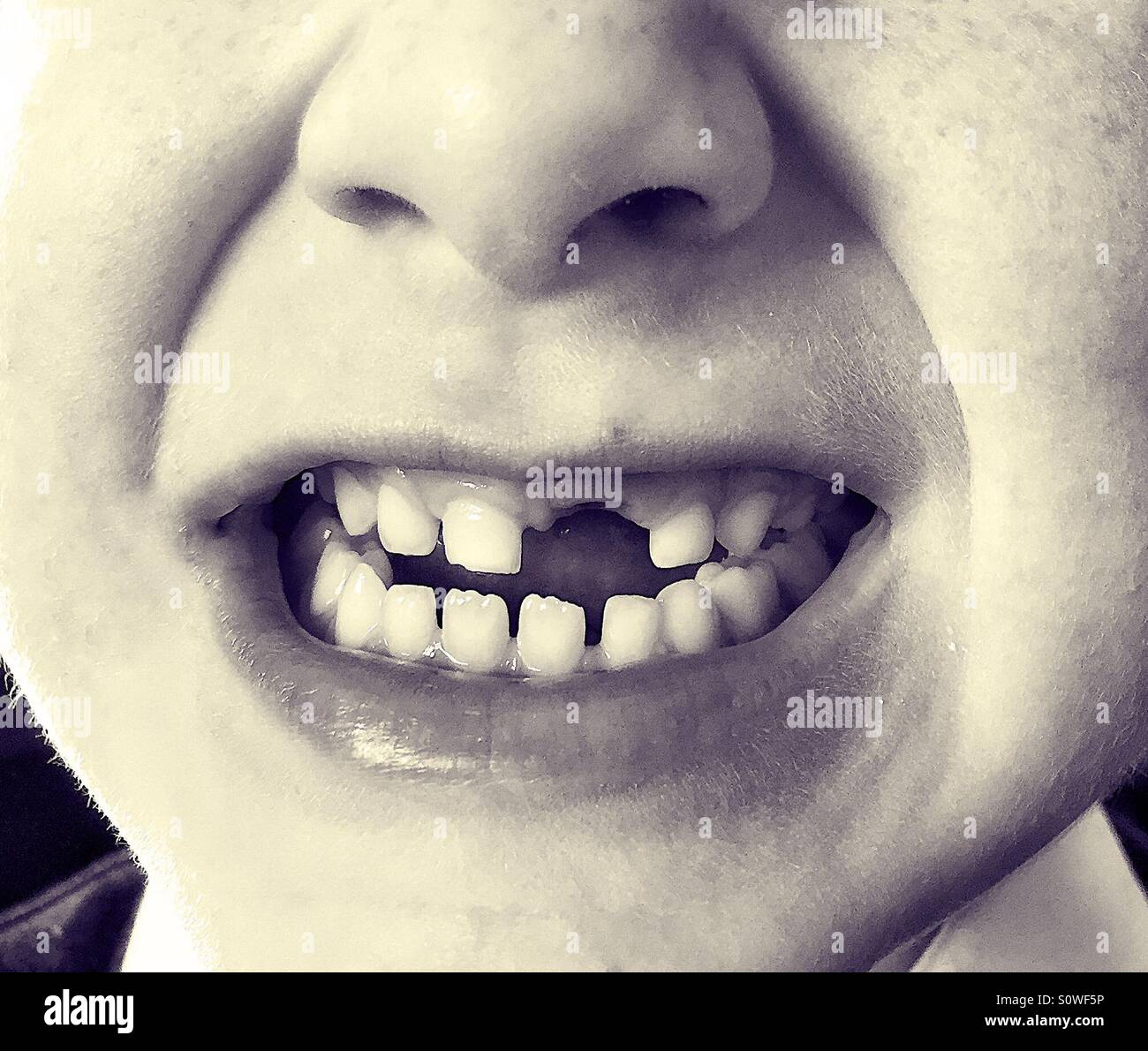 Missing Baby Teeth High Resolution Stock Photography and Images - Alamy
