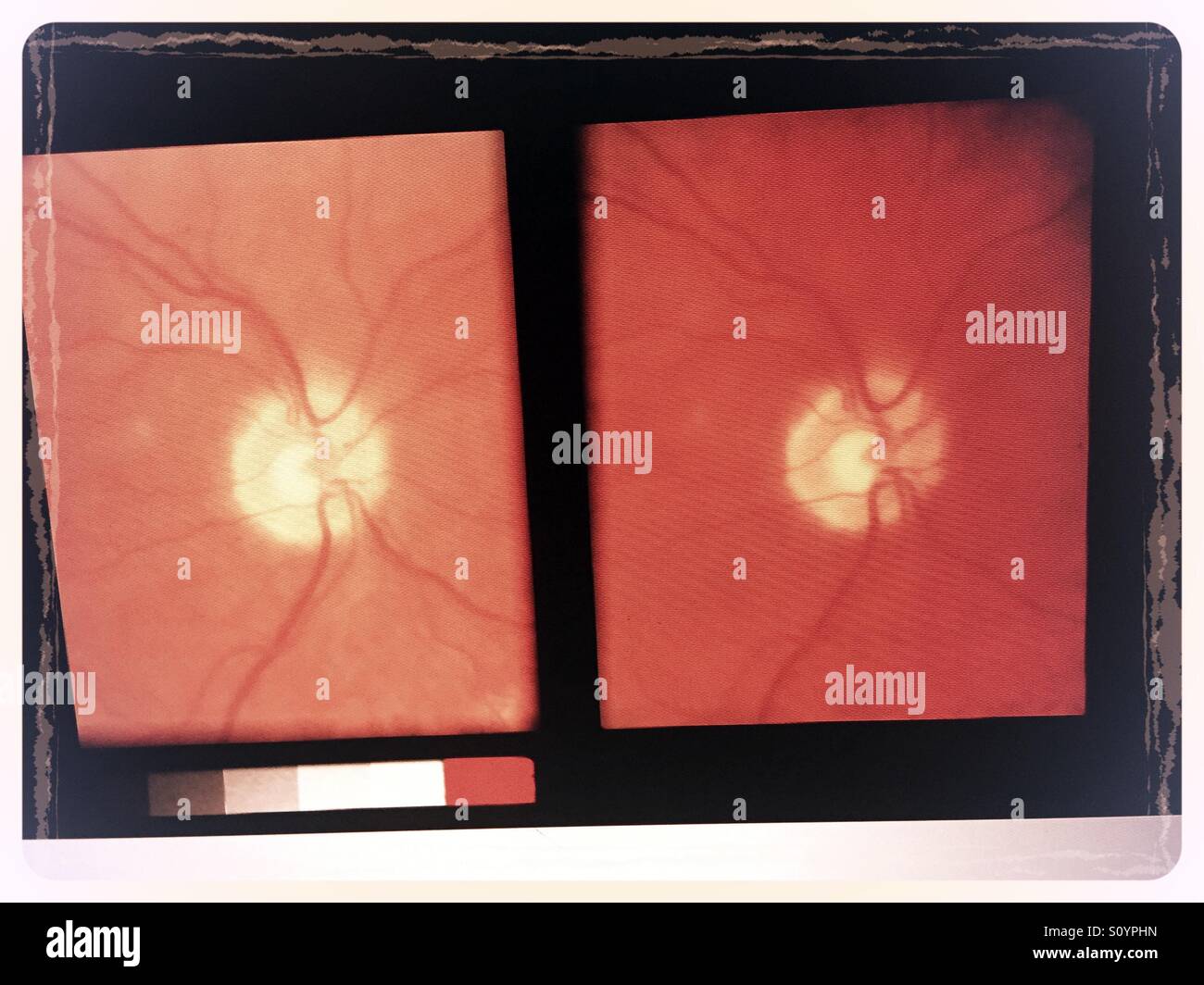 Fundus of the eye hi-res stock photography and images - Alamy