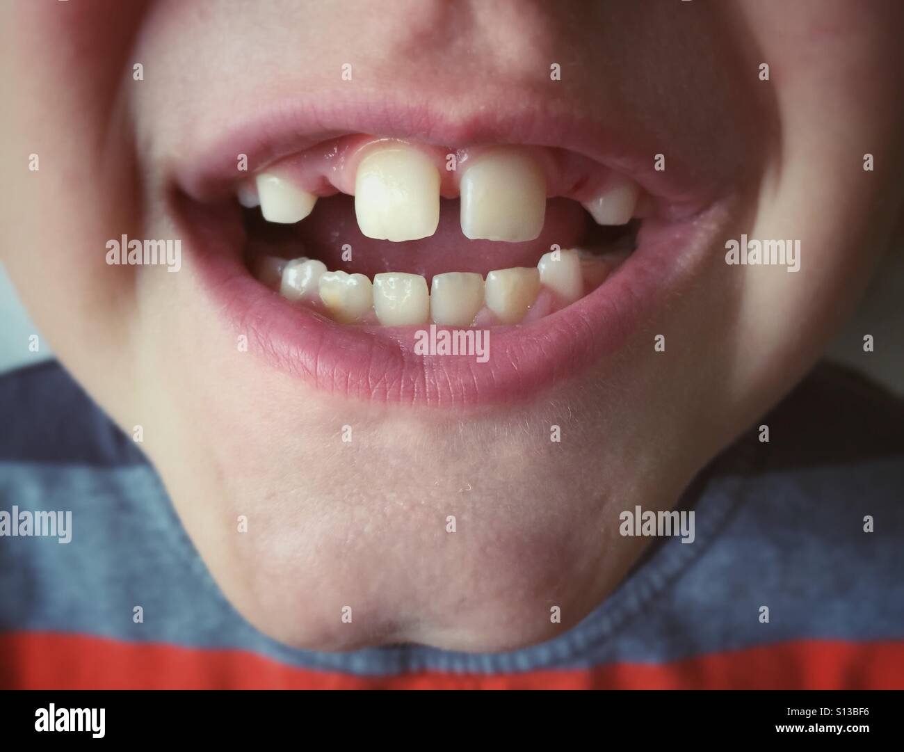 Gappy grin: a young boy's smile minus two upper teeth Stock Photo - Alamy