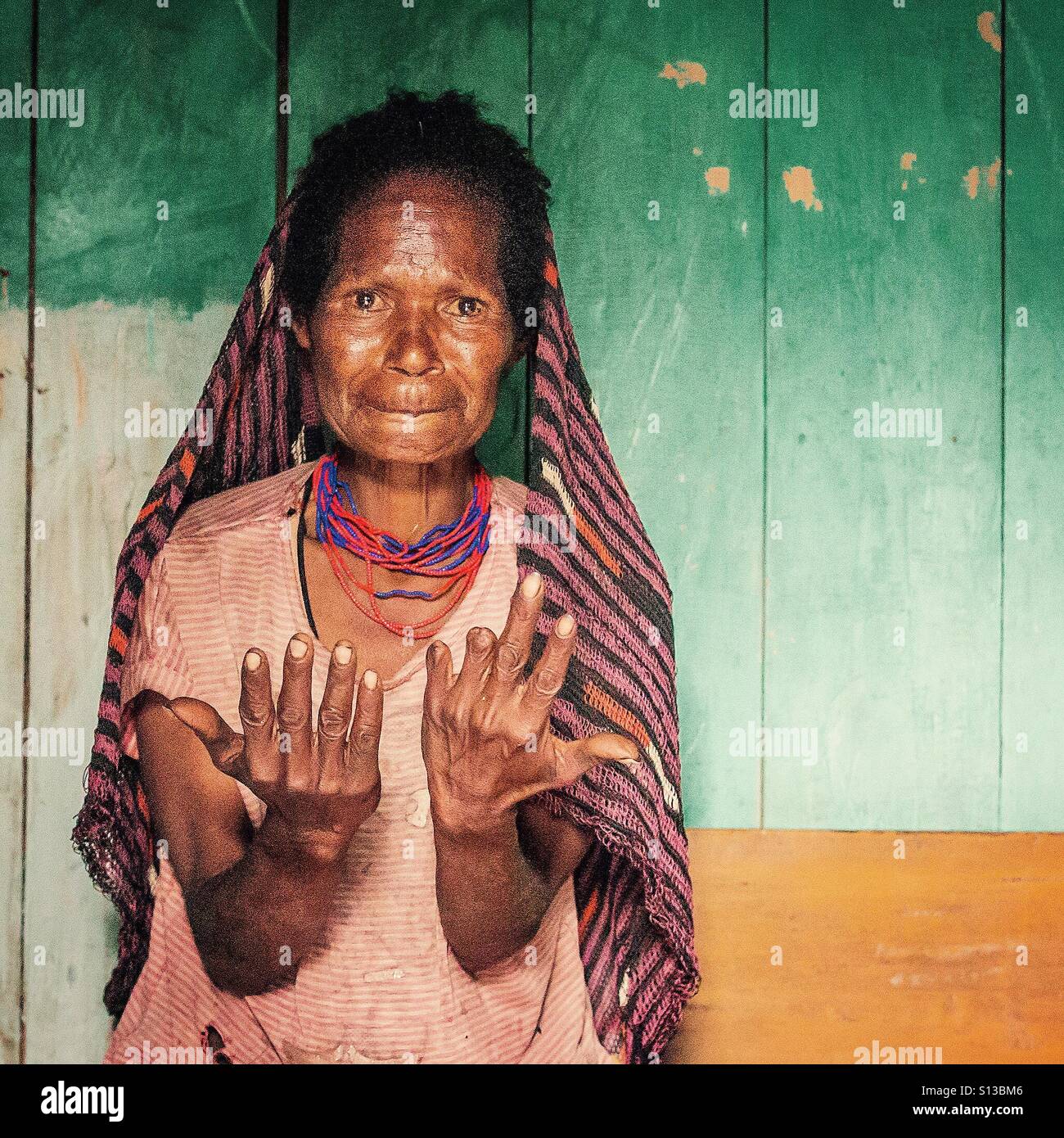 Finger missing hi-res stock photography and images - Alamy