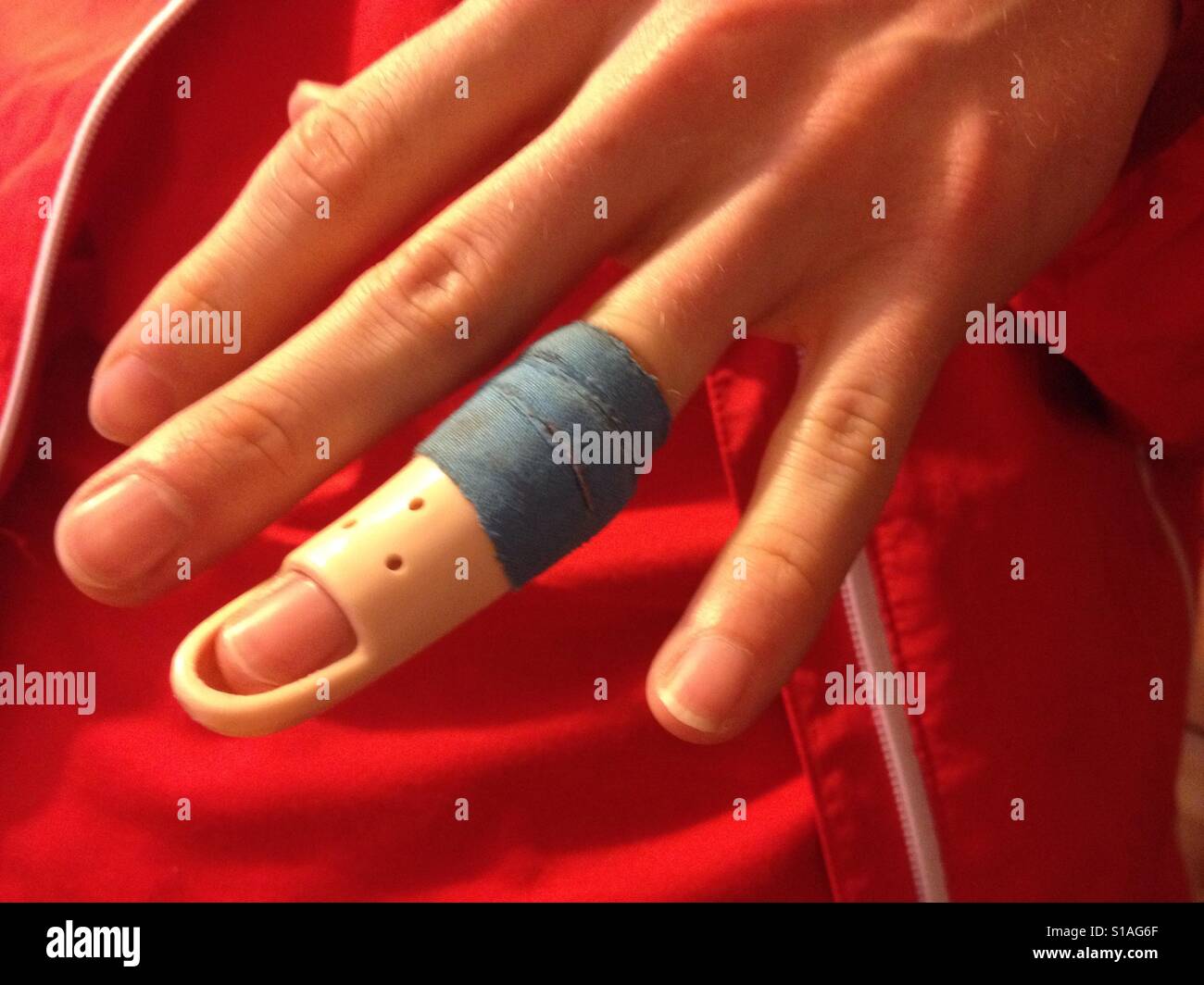 Splint Stock Photos & Splint Stock Images - Alamy