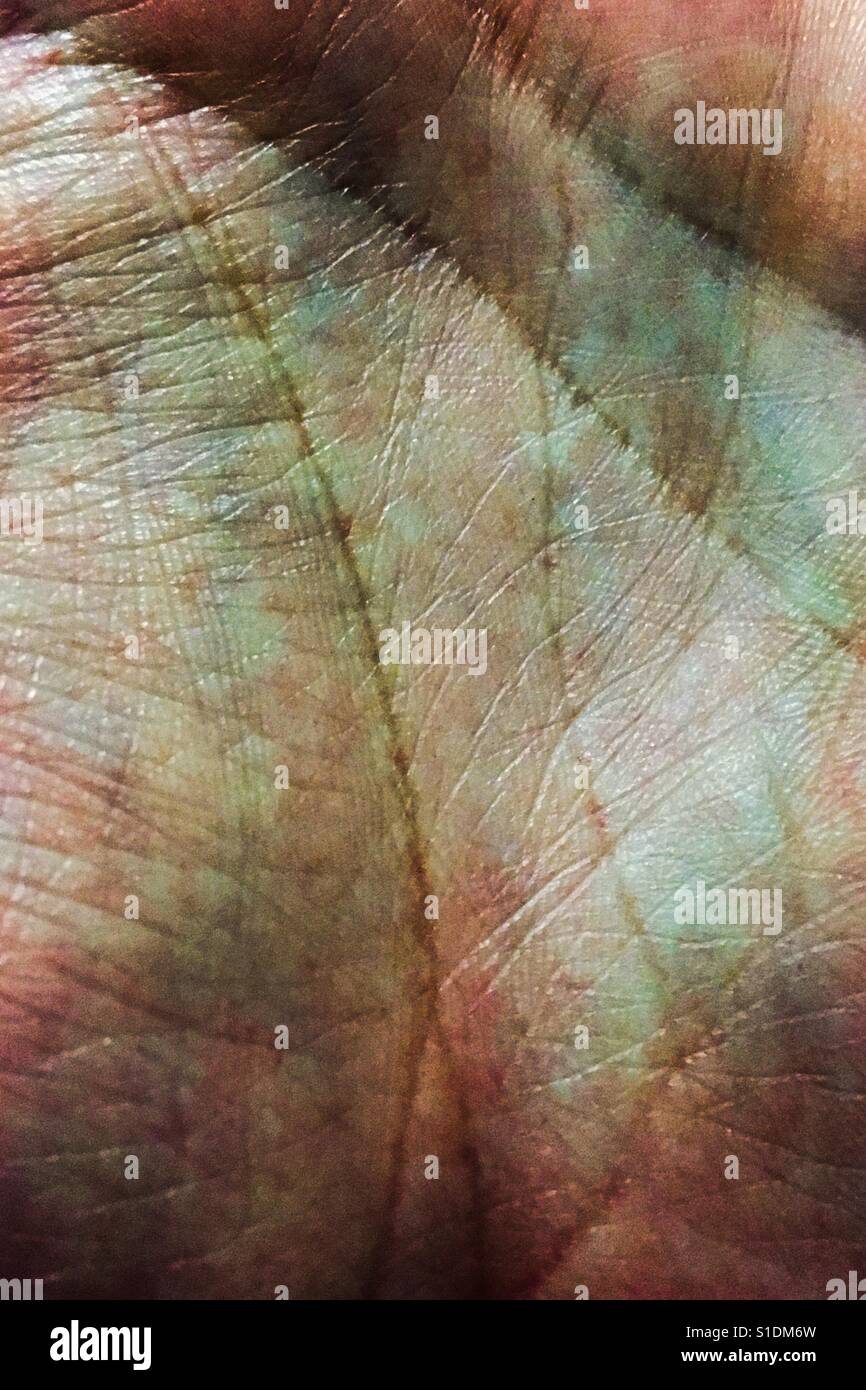 Bruised skin hi-res stock photography and images - Alamy