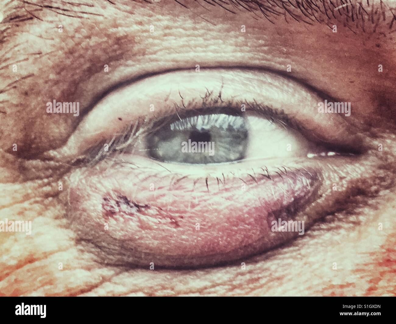 Black eye hi-res stock photography and images - Alamy