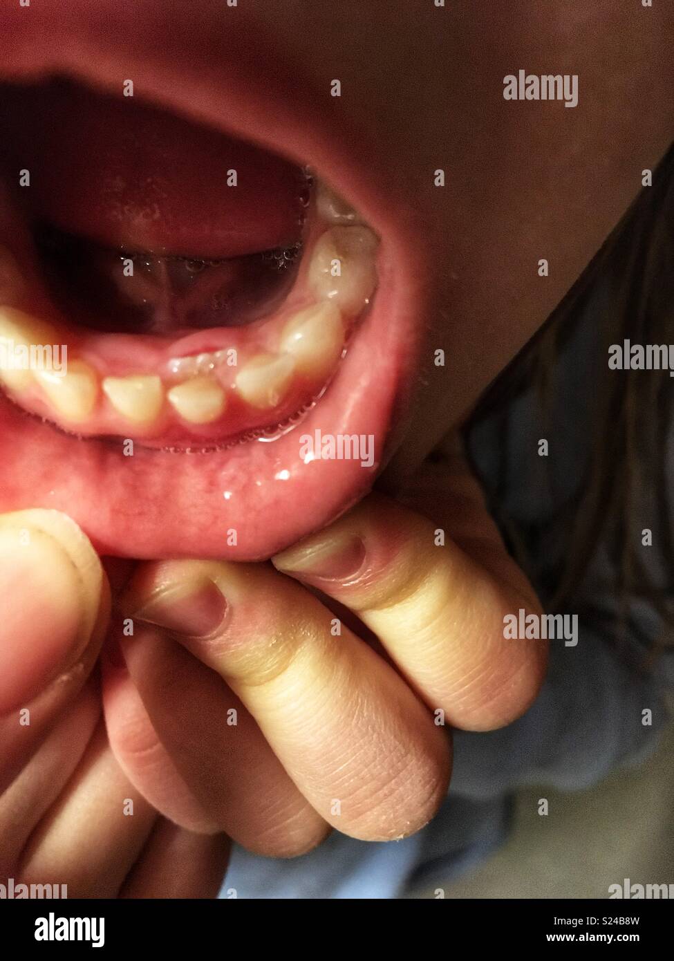 Child’s new tooth coming in Stock Photo - Alamy